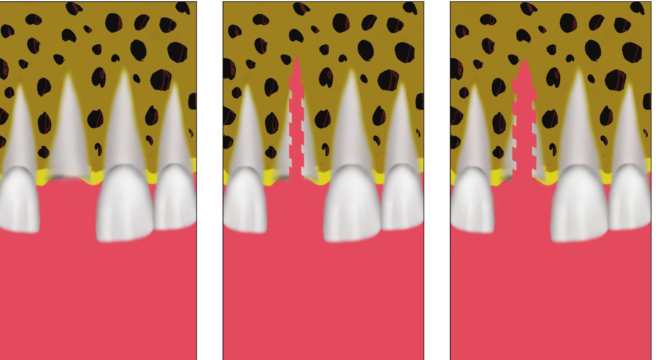 Figure 3 - A Technique for Atraumatic Extraction of Teeth