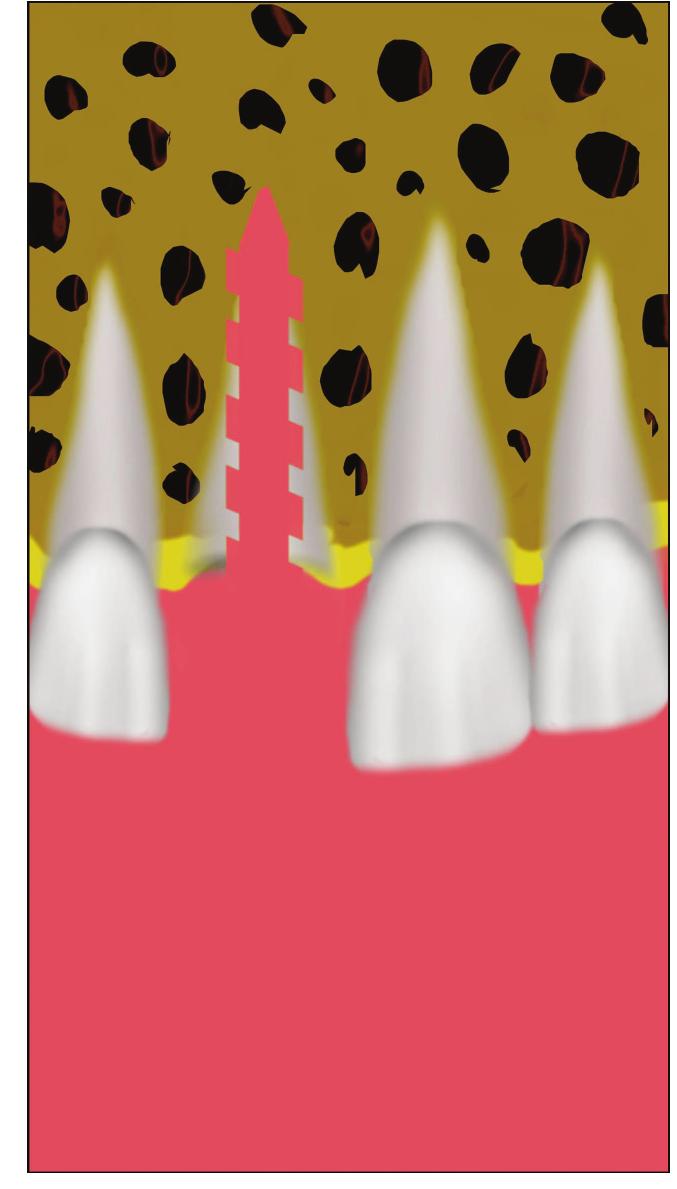 Schematic views of the new atrau- matic tooth extraction