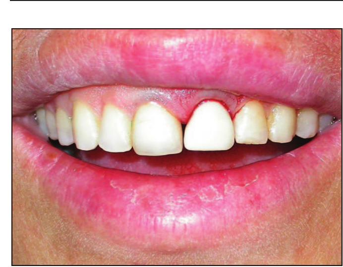 Figure 9 - A Technique for Atraumatic Extraction of Teeth