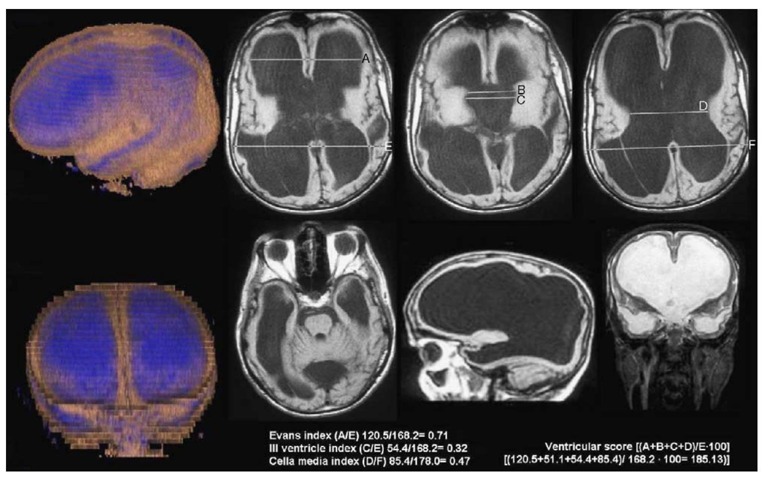 Neuroimaging shows the severity of ventriculomegaly. left:
