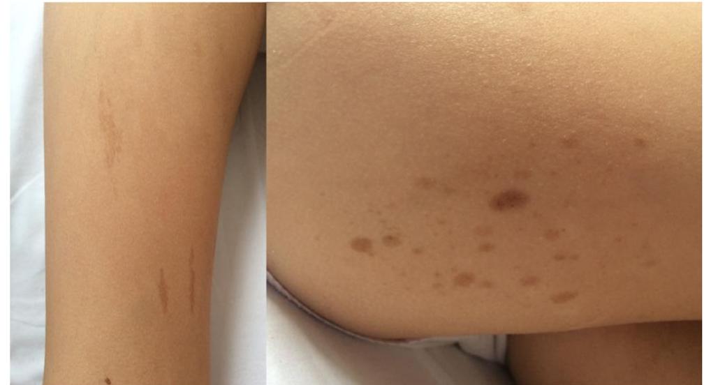 Image 1. cafe-au-lait spots on the extremities
