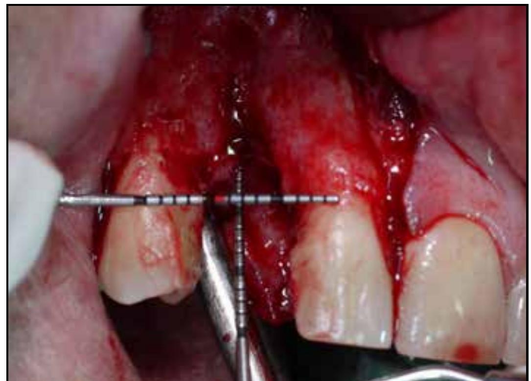E: full thickness flap exposing bone defect.