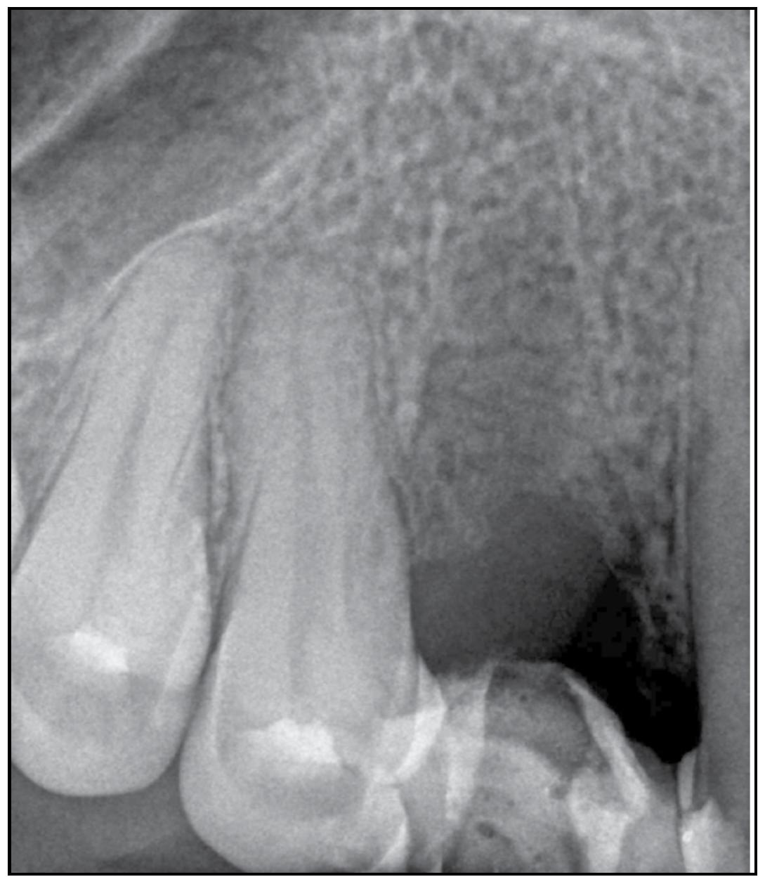 Figure 27 - Vertical Bone Augmentation and Soft Tissue