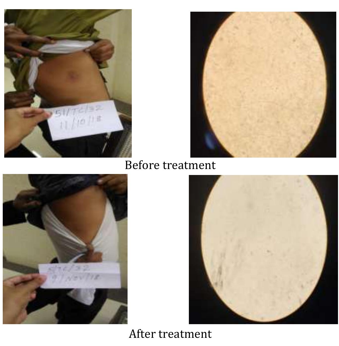Examination revealed no hyphae in skin scraping. marham
