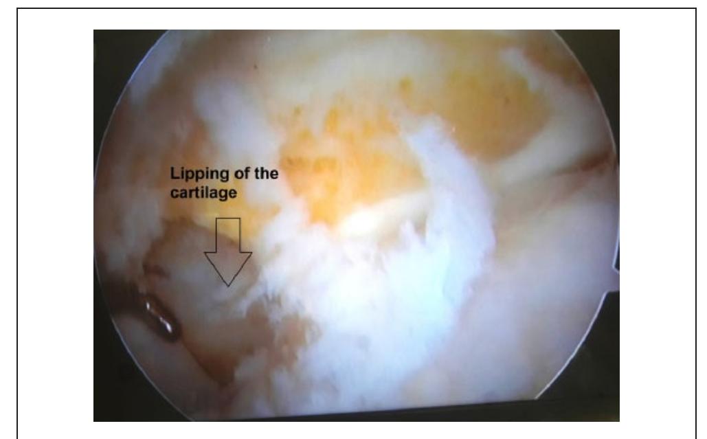 Arthroscopic view shows the forming of a lipping of the