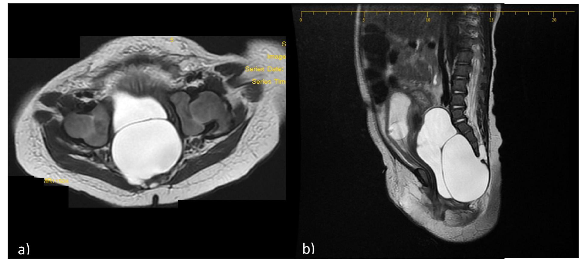 1a and 1b: axial and sagittal t2-weighted images showing a