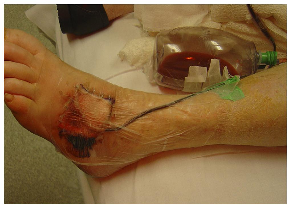 Lower limb split skin graft with disposable closed- system