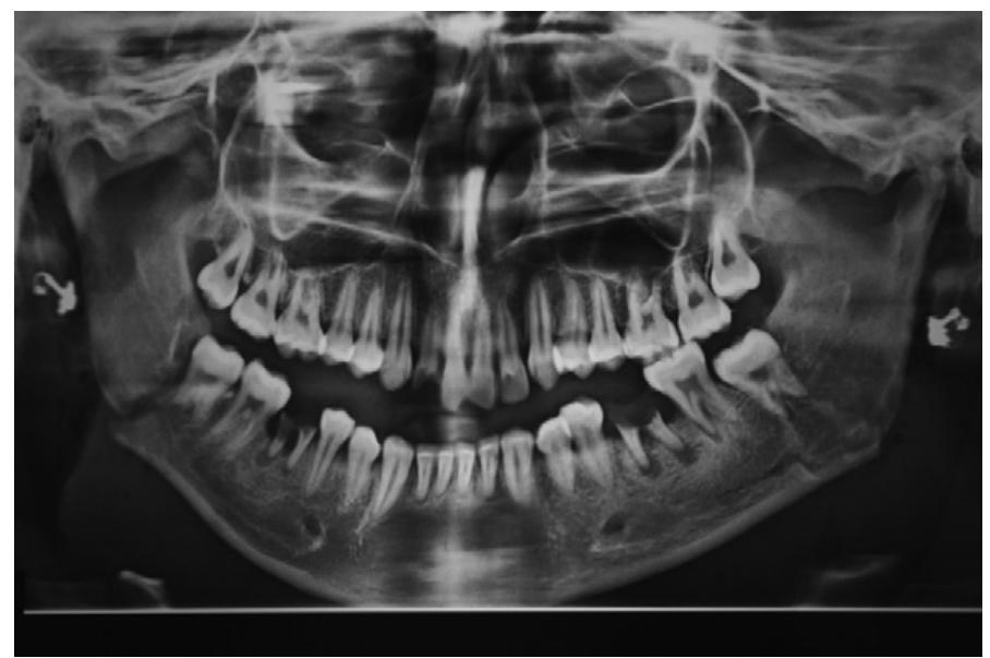 Pre-operative opg fracture bilateral angle of mandible. the