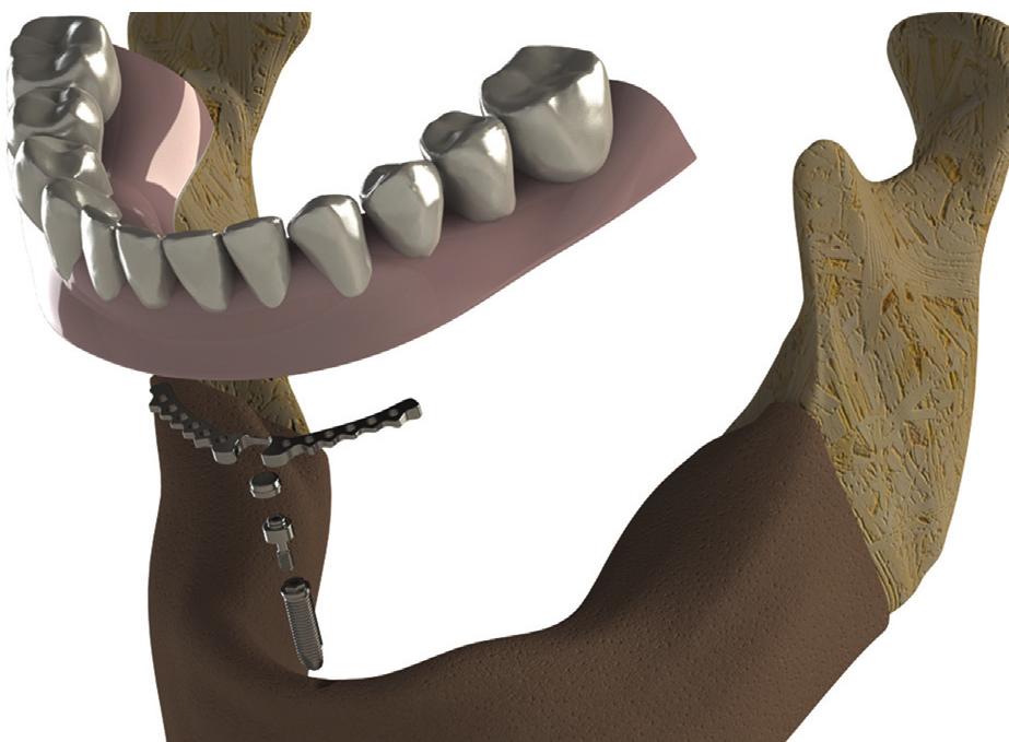 Exploded view of 3-dimensional finite element model of