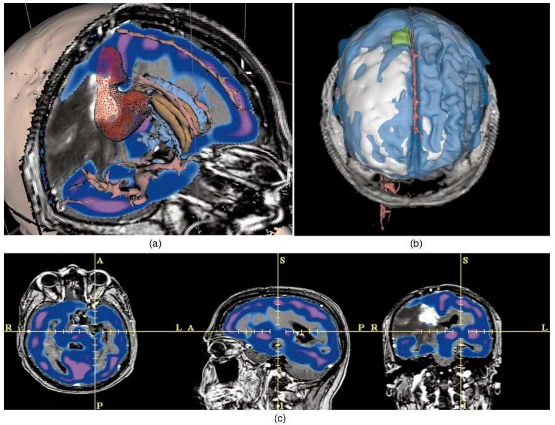Intensity-based registration of an mri and an integrated