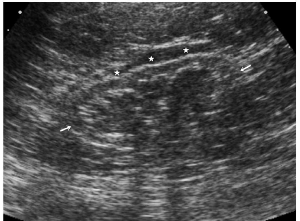 (PDF) Sonography of perinephric fluid collections: A pictorial essay