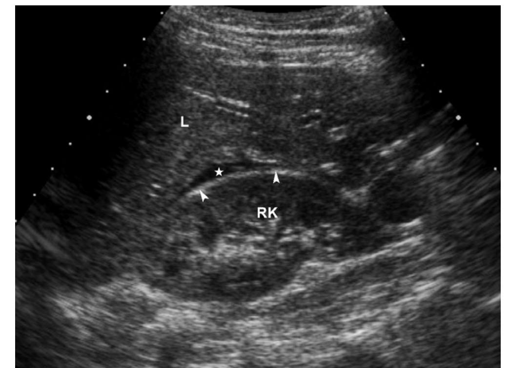 (PDF) Sonography of perinephric fluid collections: A pictorial essay