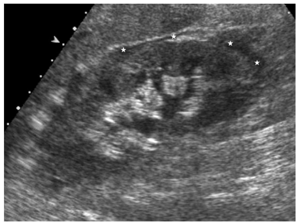 (PDF) Sonography of perinephric fluid collections: A pictorial essay