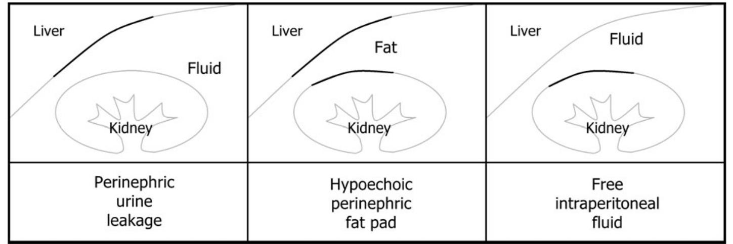 (PDF) Sonography of perinephric fluid collections: A pictorial essay