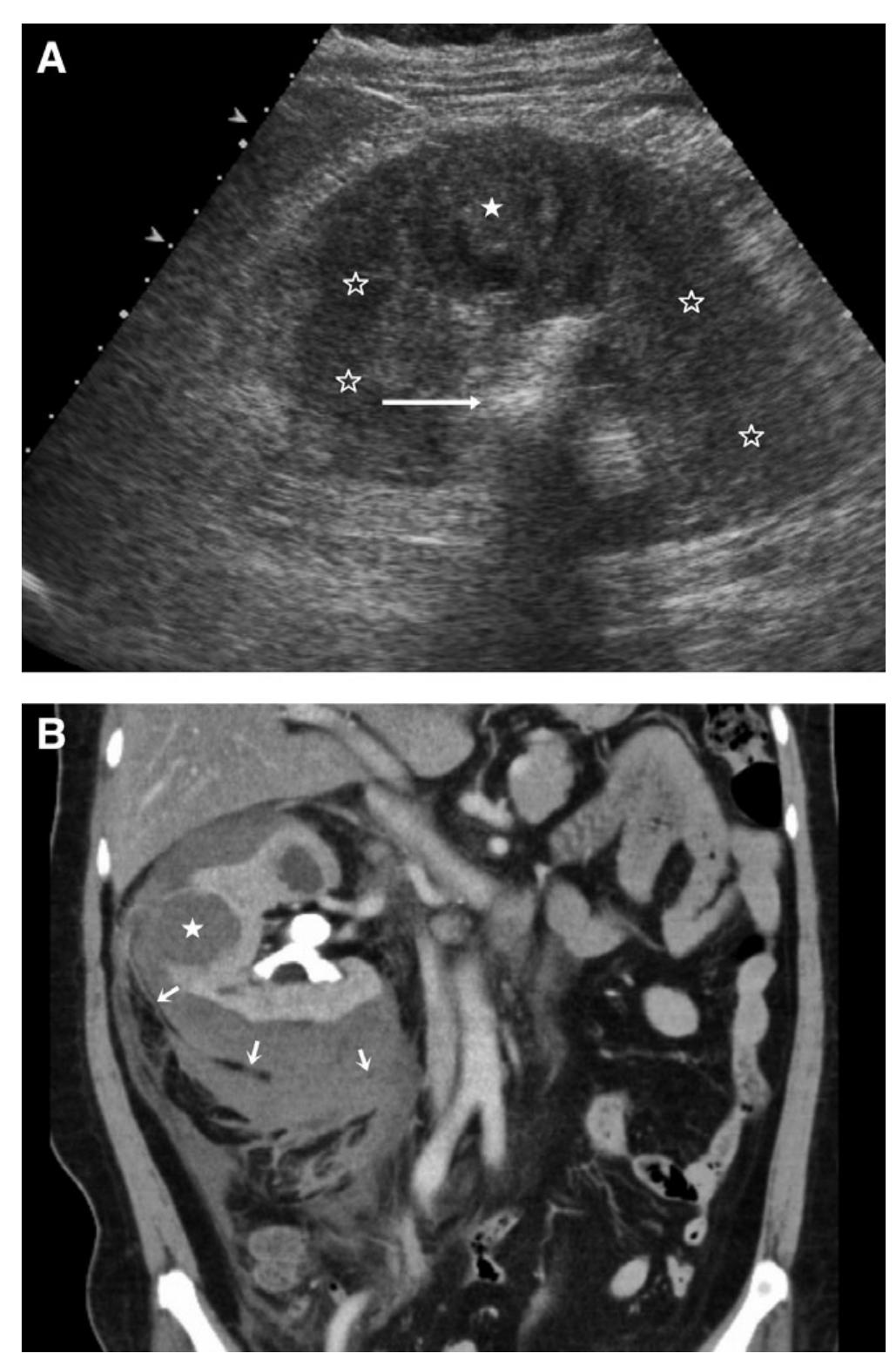 (PDF) Sonography of perinephric fluid collections: A pictorial essay