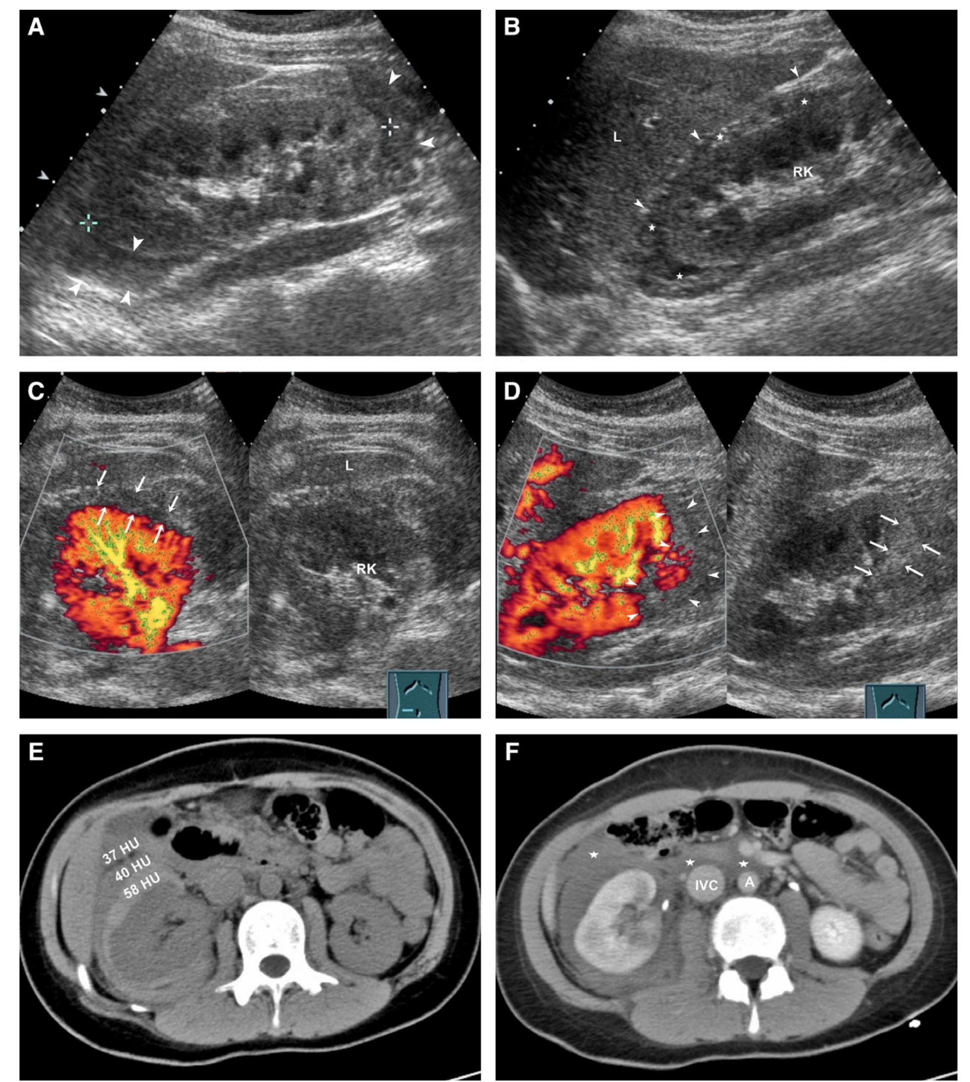 (PDF) Sonography of perinephric fluid collections: A pictorial essay