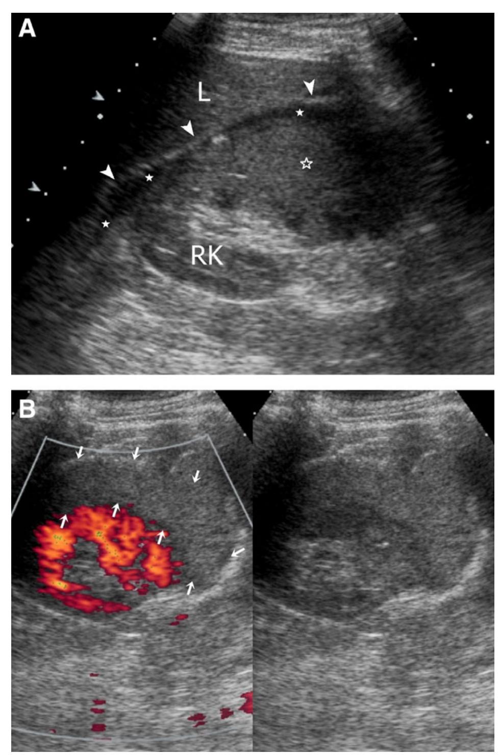 (PDF) Sonography of perinephric fluid collections: A pictorial essay