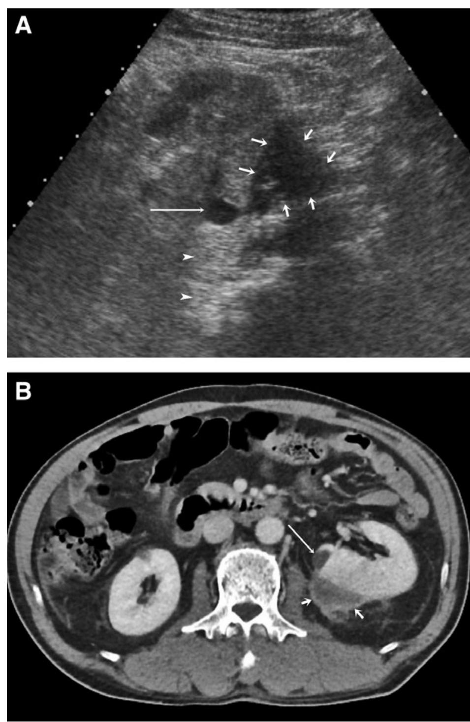 (PDF) Sonography of perinephric fluid collections: A pictorial essay