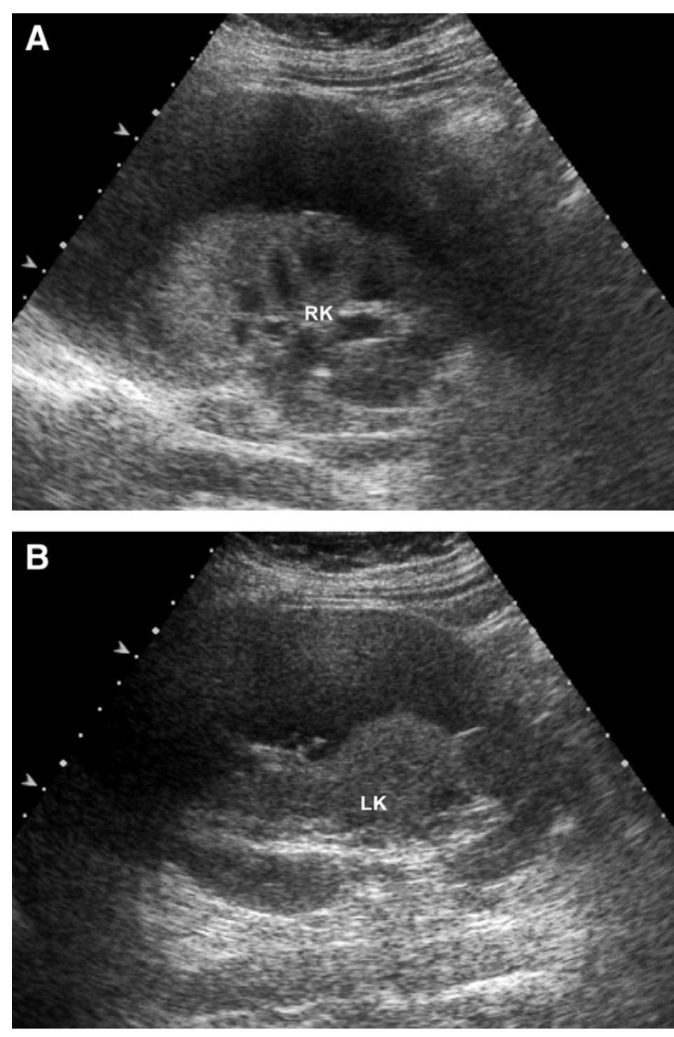 (PDF) Sonography of perinephric fluid collections: A pictorial essay