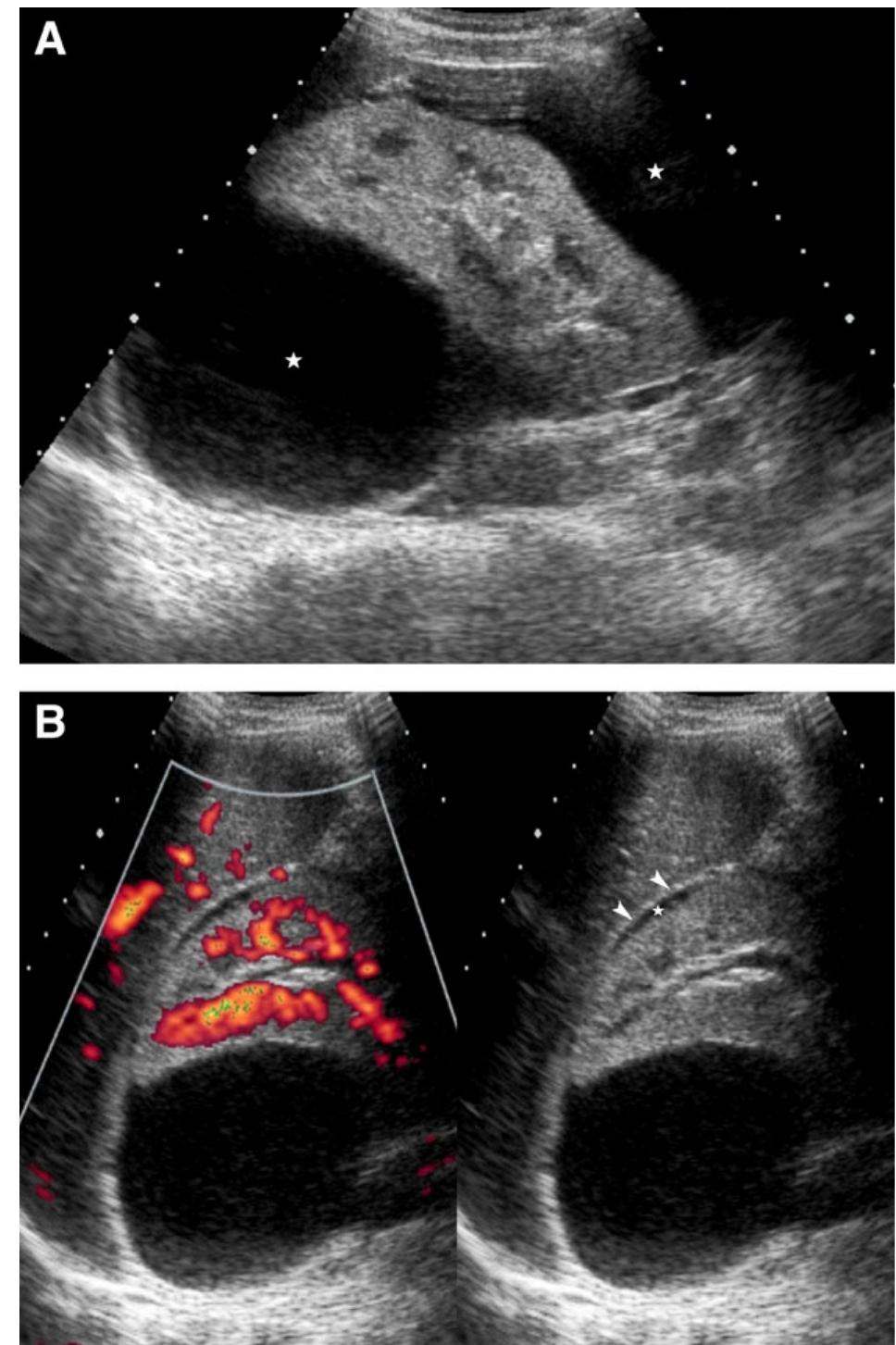 (PDF) Sonography of perinephric fluid collections: A pictorial essay