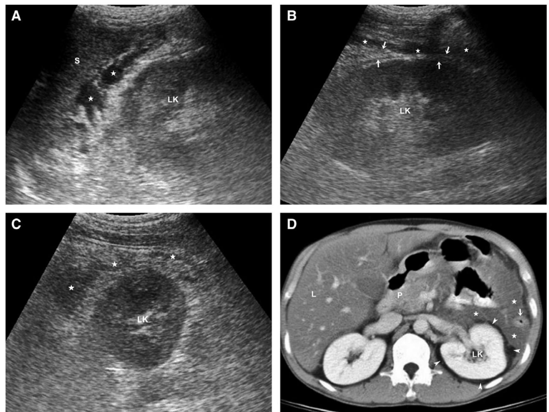(PDF) Sonography of perinephric fluid collections: A pictorial essay