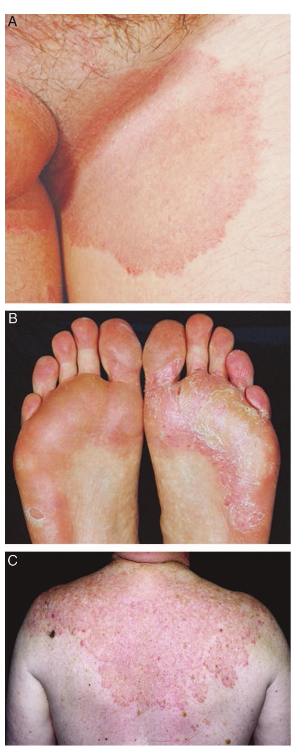 A, tinea cruris; b, tinea pedis; c, tinea corporis.