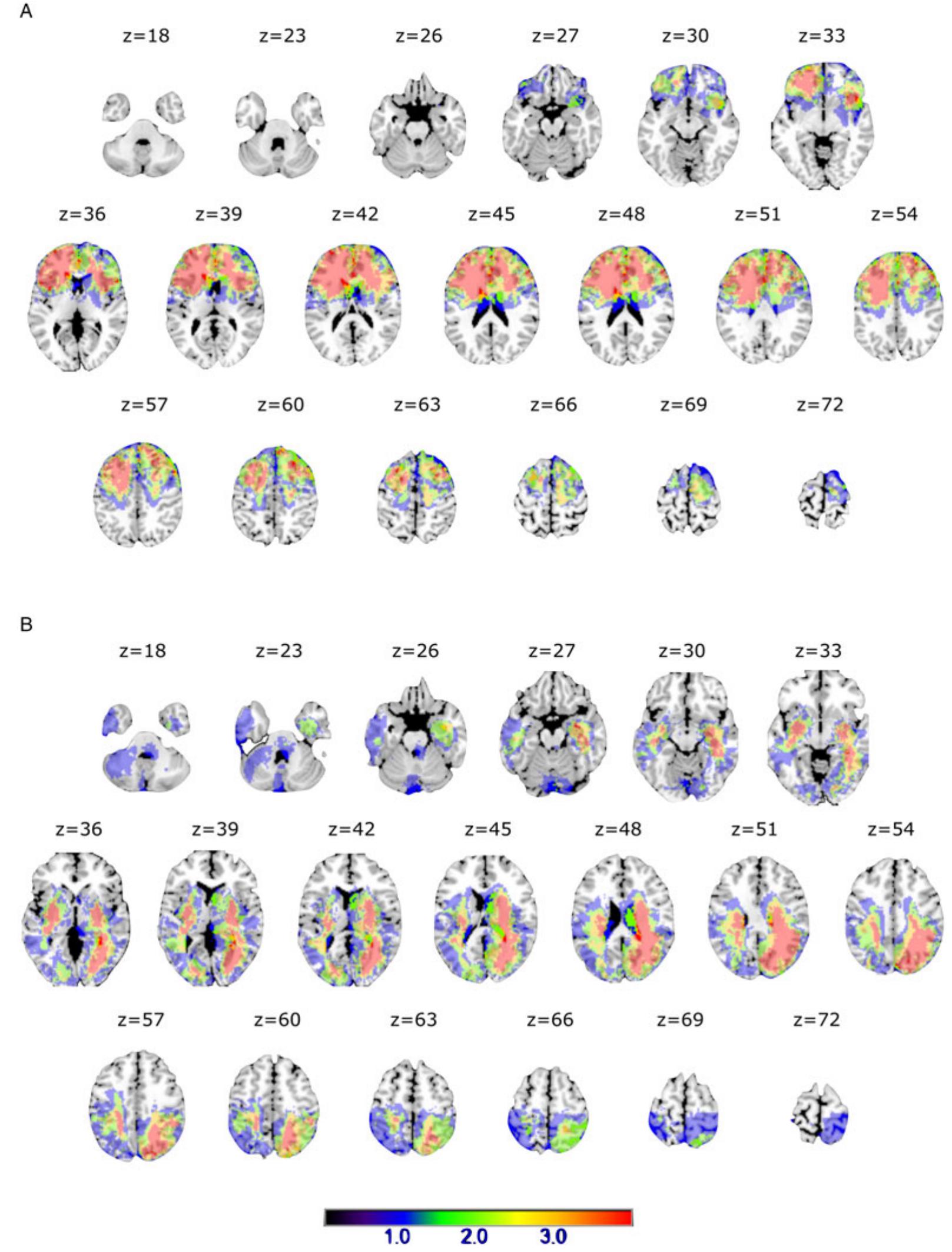 Lesion distribution volume map for (a) frontal and (b)
