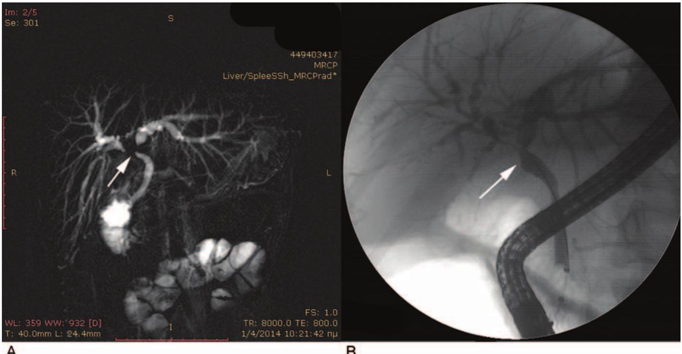 Mrcp (a) and ercp (b) findings showing a dominant stricture