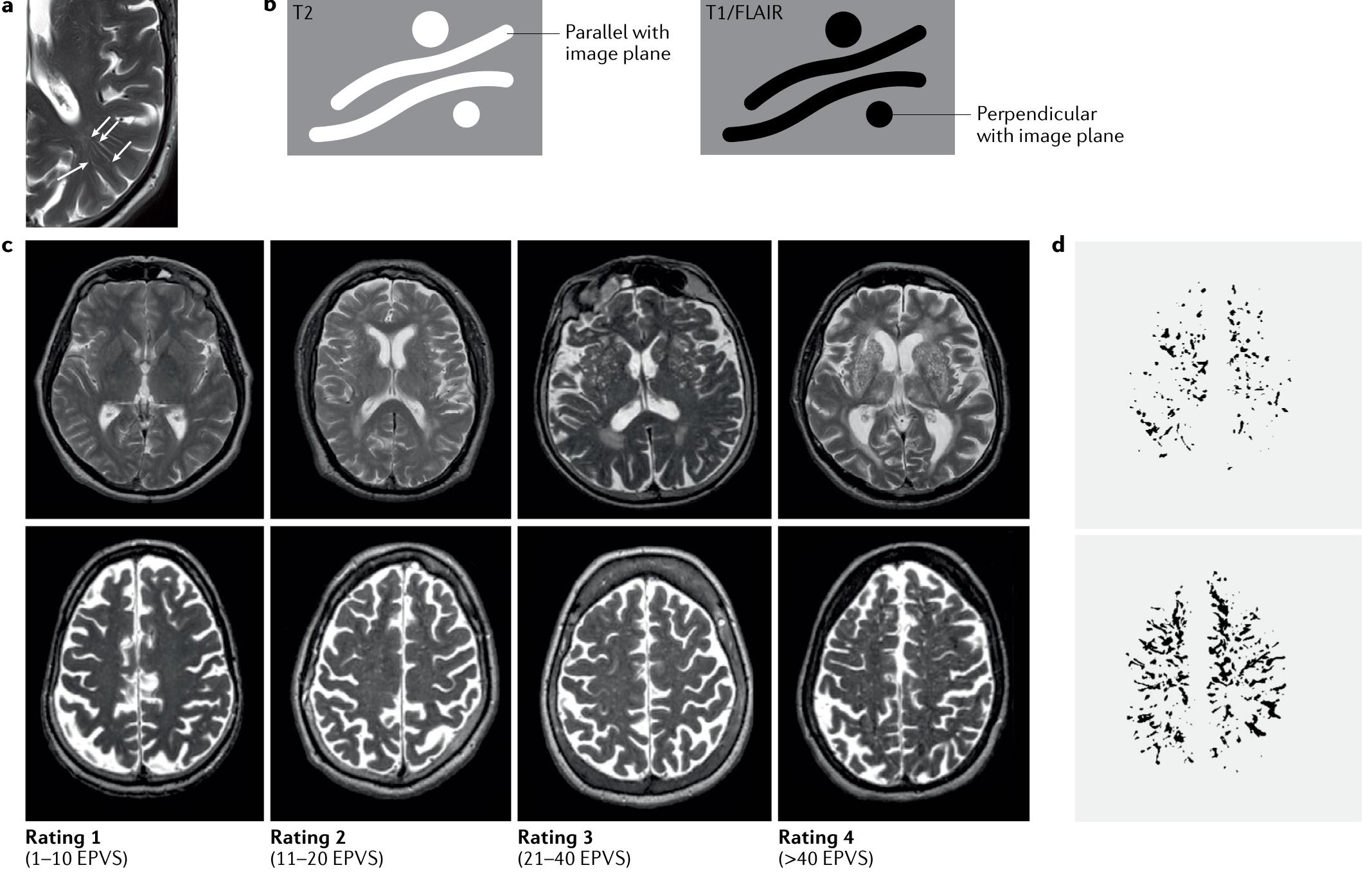 | perivascular spaces visualized with mri in humans. a|