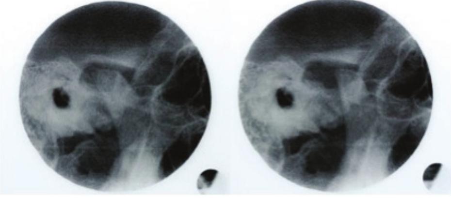- transcranial radiograph with occlusal splint.