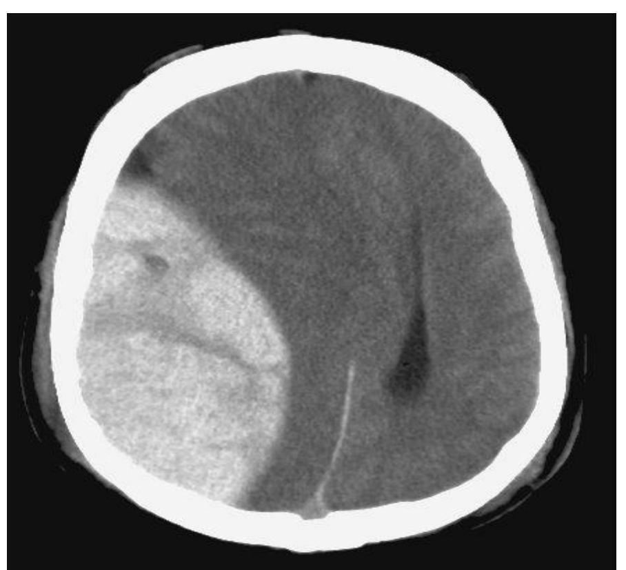 -2: image depicting typical acute epidural hemorrhage in