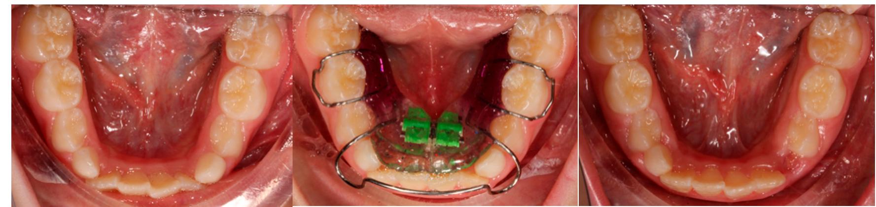 Clinical case: patient treated with the mandibular schwartz