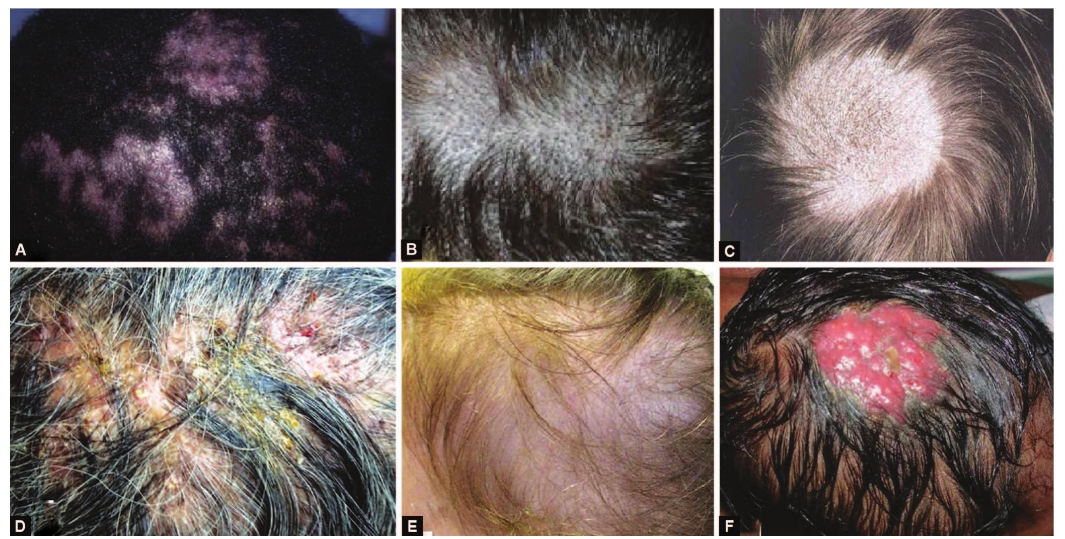 S 1a to f: (a) tinea capitis; (b) black dot variant, showing