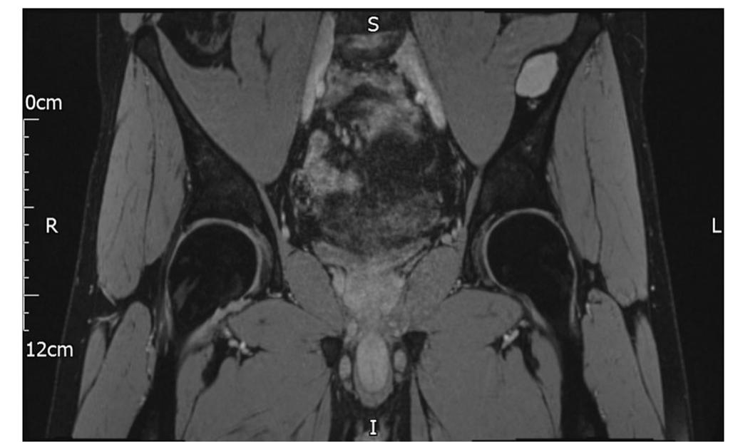 Volumetric t2 gradient coronal sequence with fat suppression