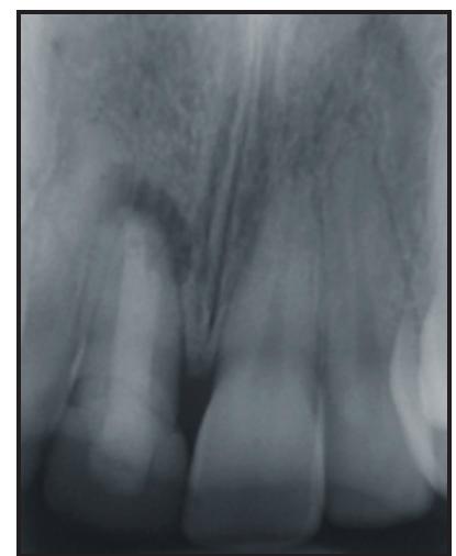 Patient presented with pain and mobility of tooth #8(11),