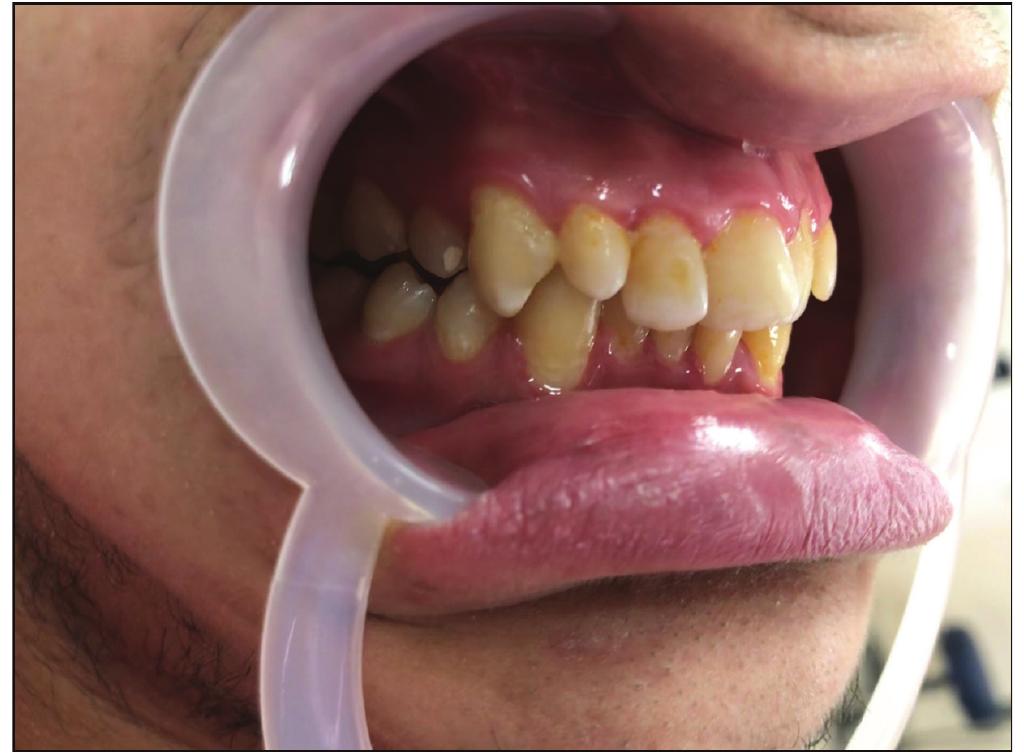 Clinical image showing a maxillary right conical