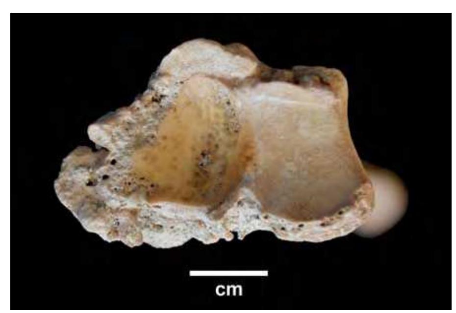 Distal radial articular surface with eburnation and rthritic