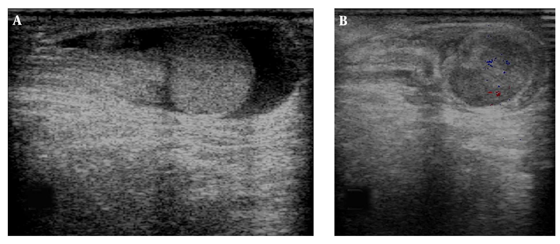 The spermatic cord shape in epididymitis and testicular