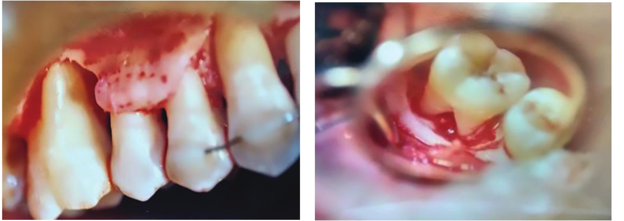 (PDF) Periodontal Osseous Defects: A Review