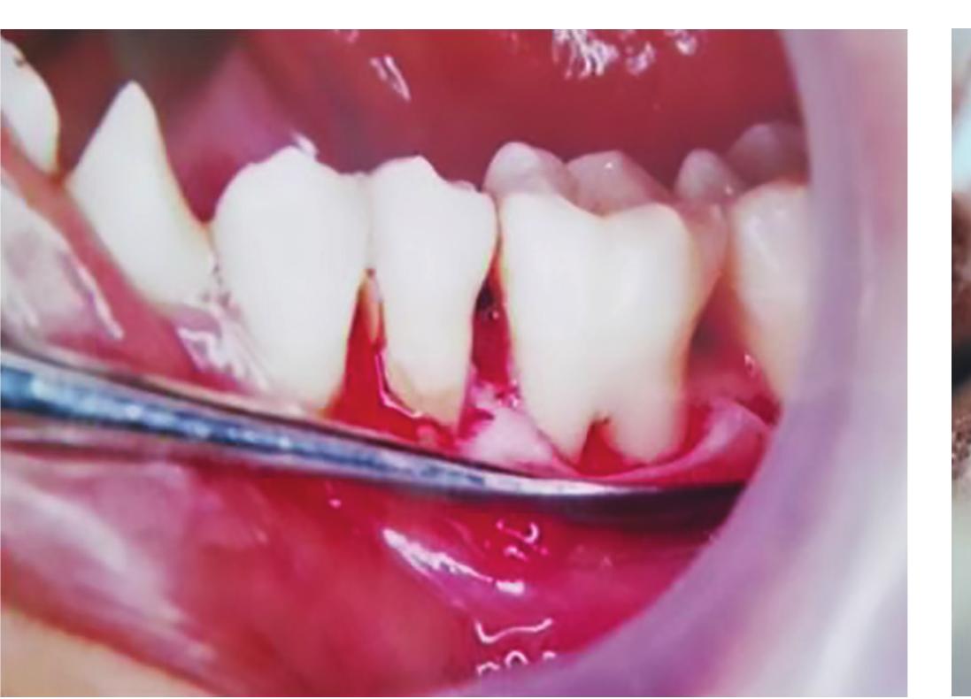 Figure 10 - Periodontal Osseous Defects: A Review