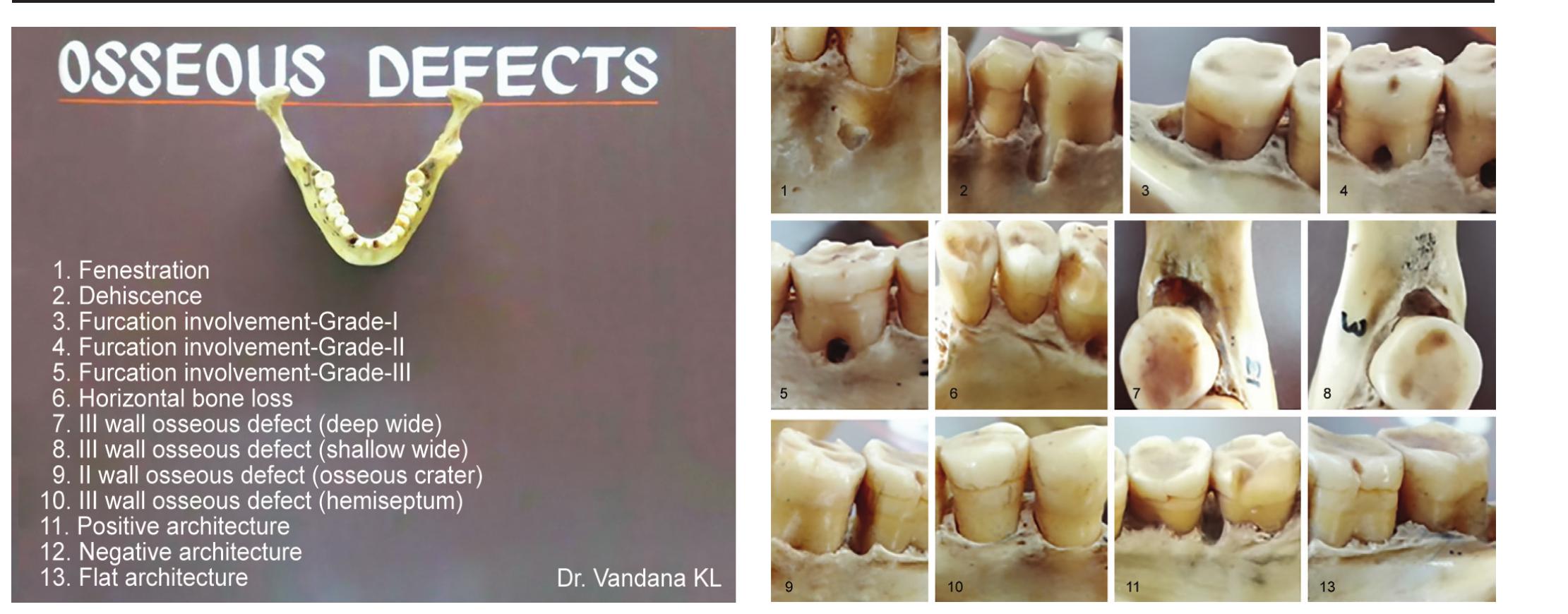 (PDF) Periodontal Osseous Defects: A Review