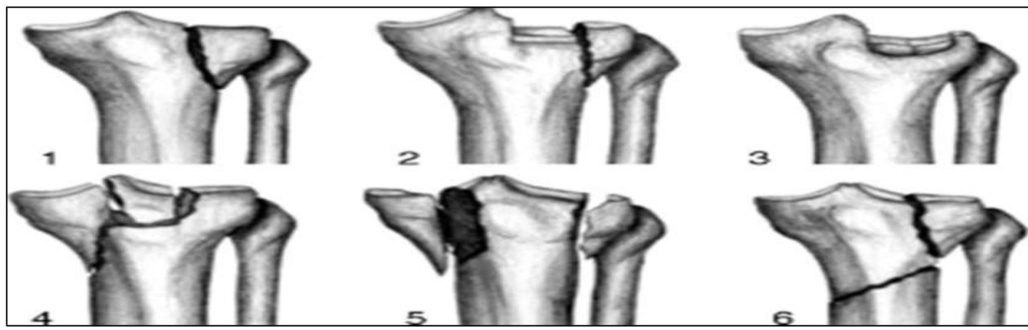 Schatzker classification of tibial platue fracture.
