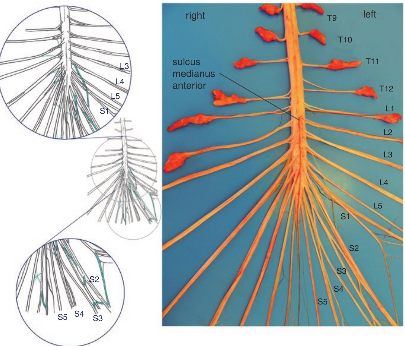 10 lumbosacral plexus, ventral view. asymmetry of roots,