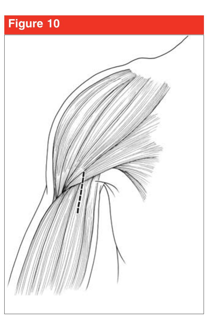 Open subpectoralis biceps tenodesis incision (dashed line).