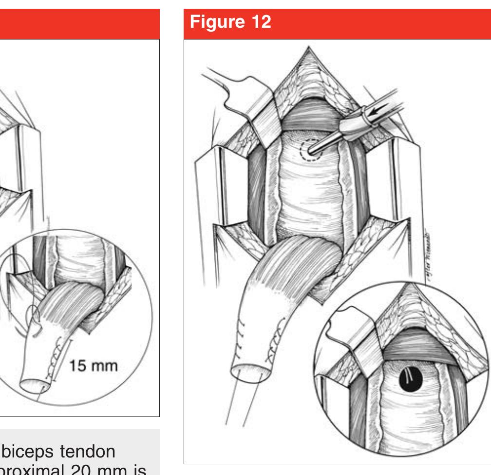 Biceps tenodesis site preparation. a guidewire is positioned