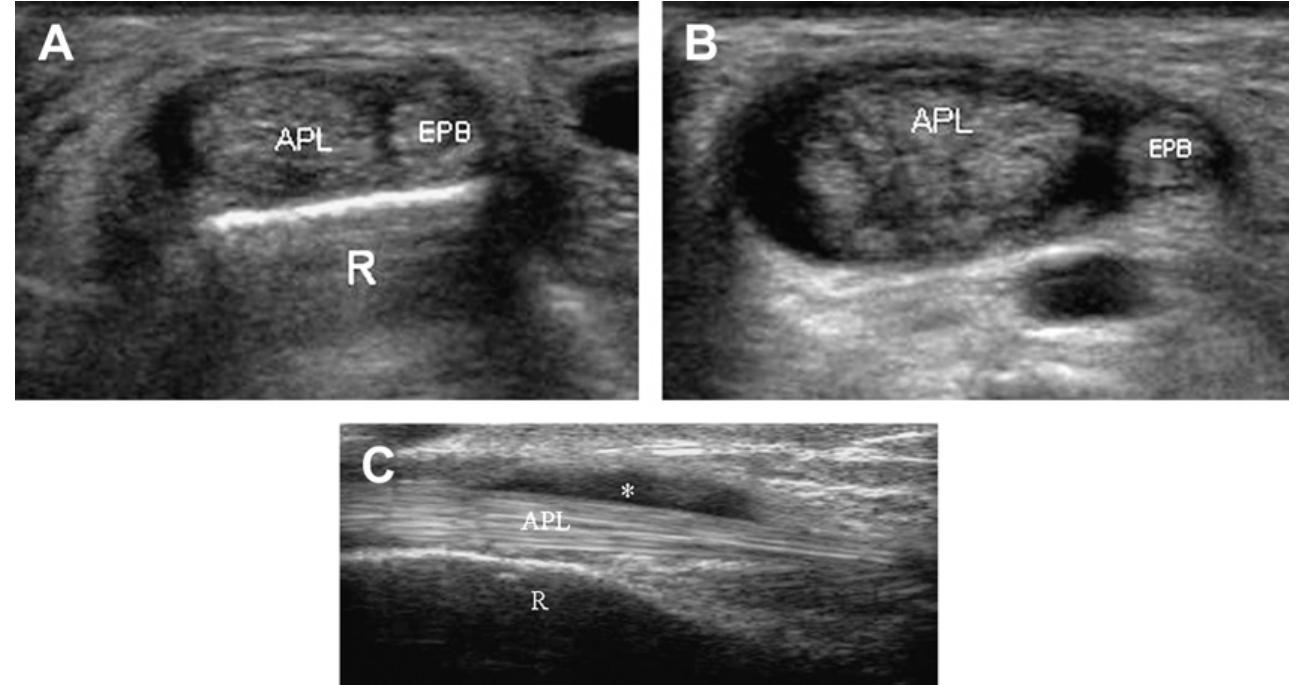 De quervain tenosynovitis. (a) short-axis views of the apl