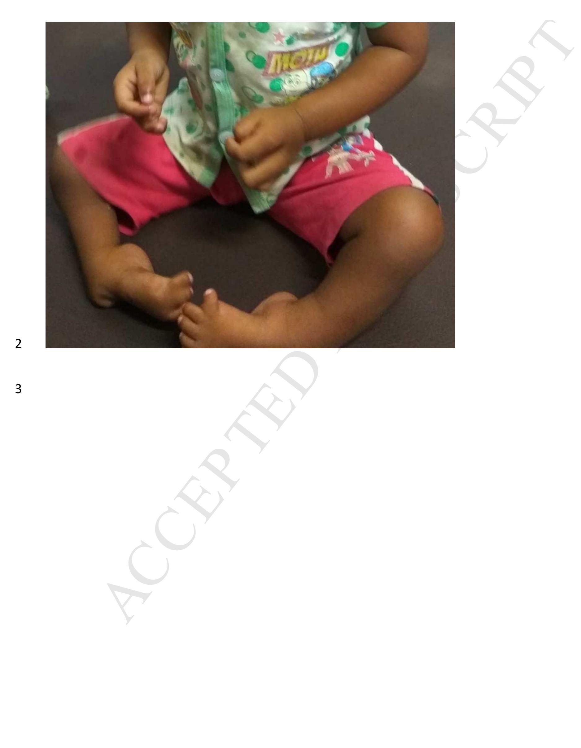 Figure 12 - Clinical spectrum of congenital tibial hemimelia
