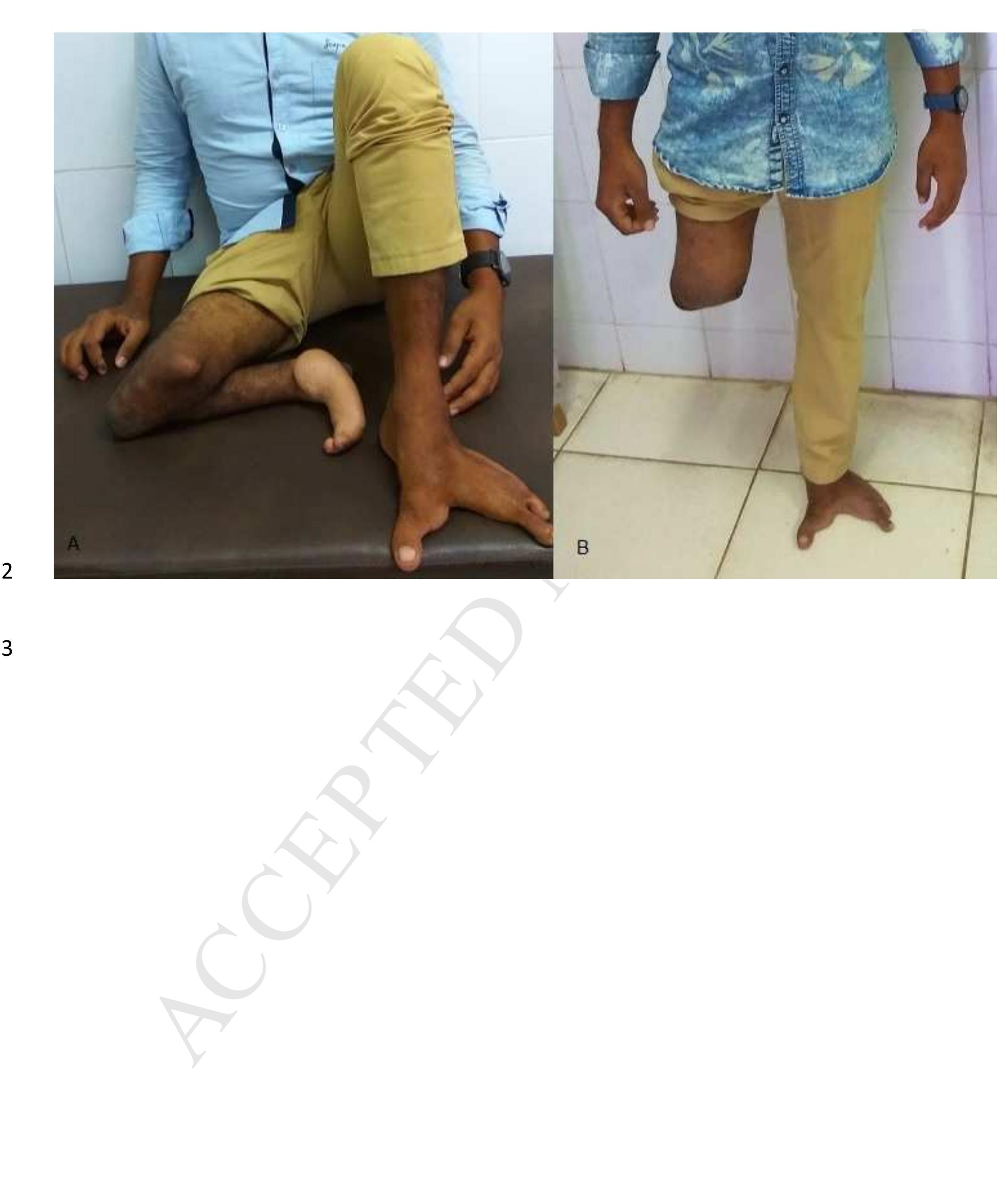 Figure 14 - Clinical spectrum of congenital tibial hemimelia