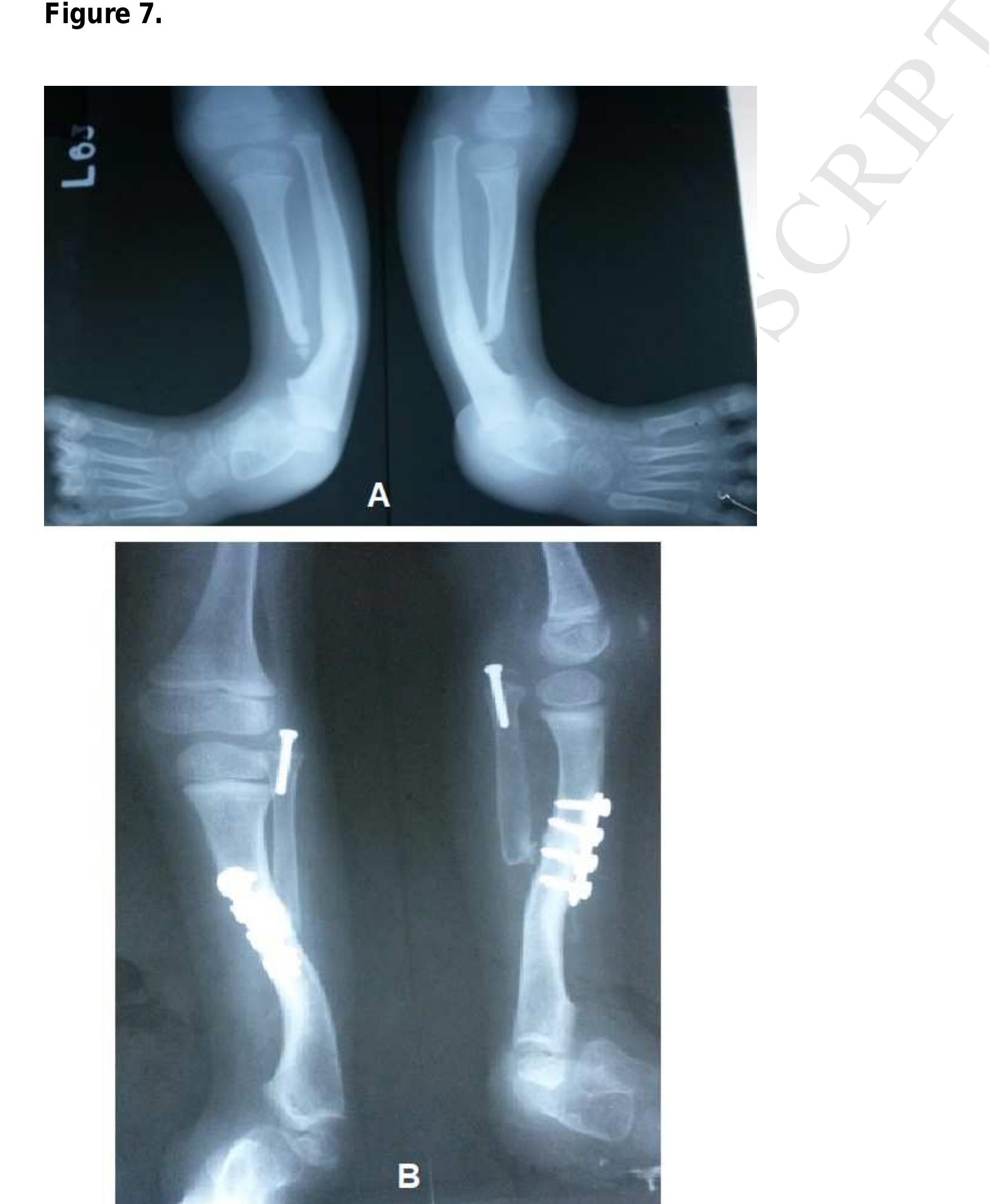 Figure 16 - Clinical spectrum of congenital tibial hemimelia