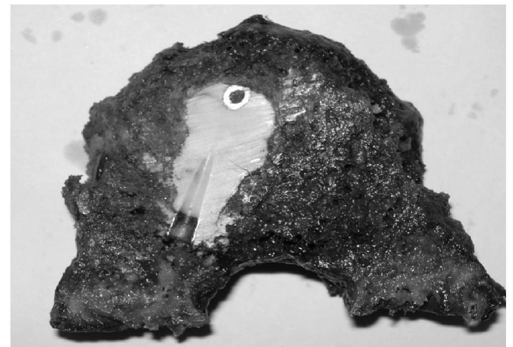 The cross section of vertebra augmented by vessel-x with